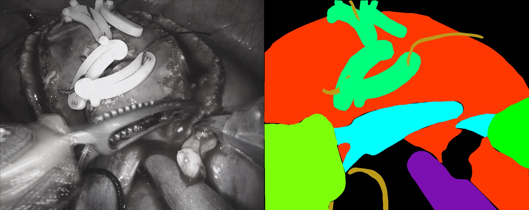 Safer Minimally Invasive Surgery With 2D Semantic Segmentation